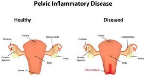 Pelvic Inflammatory Disease Treatment NYC | PID Specialist Midtown & UES