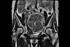 Hysteroscopic Myomectomy NYC · Fibroids Specialist Midtown, Manhattan & UES